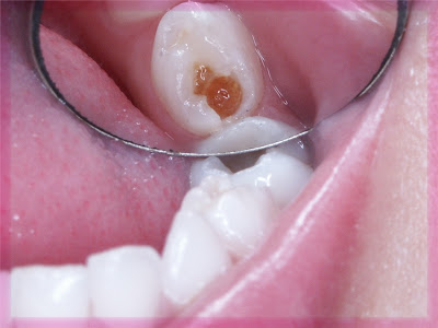 FRENKENKLINIK: Karies