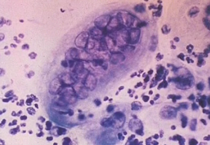 Varicella Zoster - New