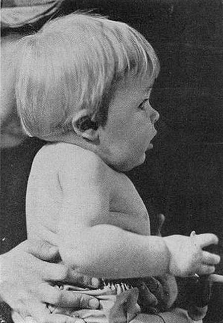 Klippel-Feil Syndrome Pictures | Medical Pictures and Images - (2023 ...