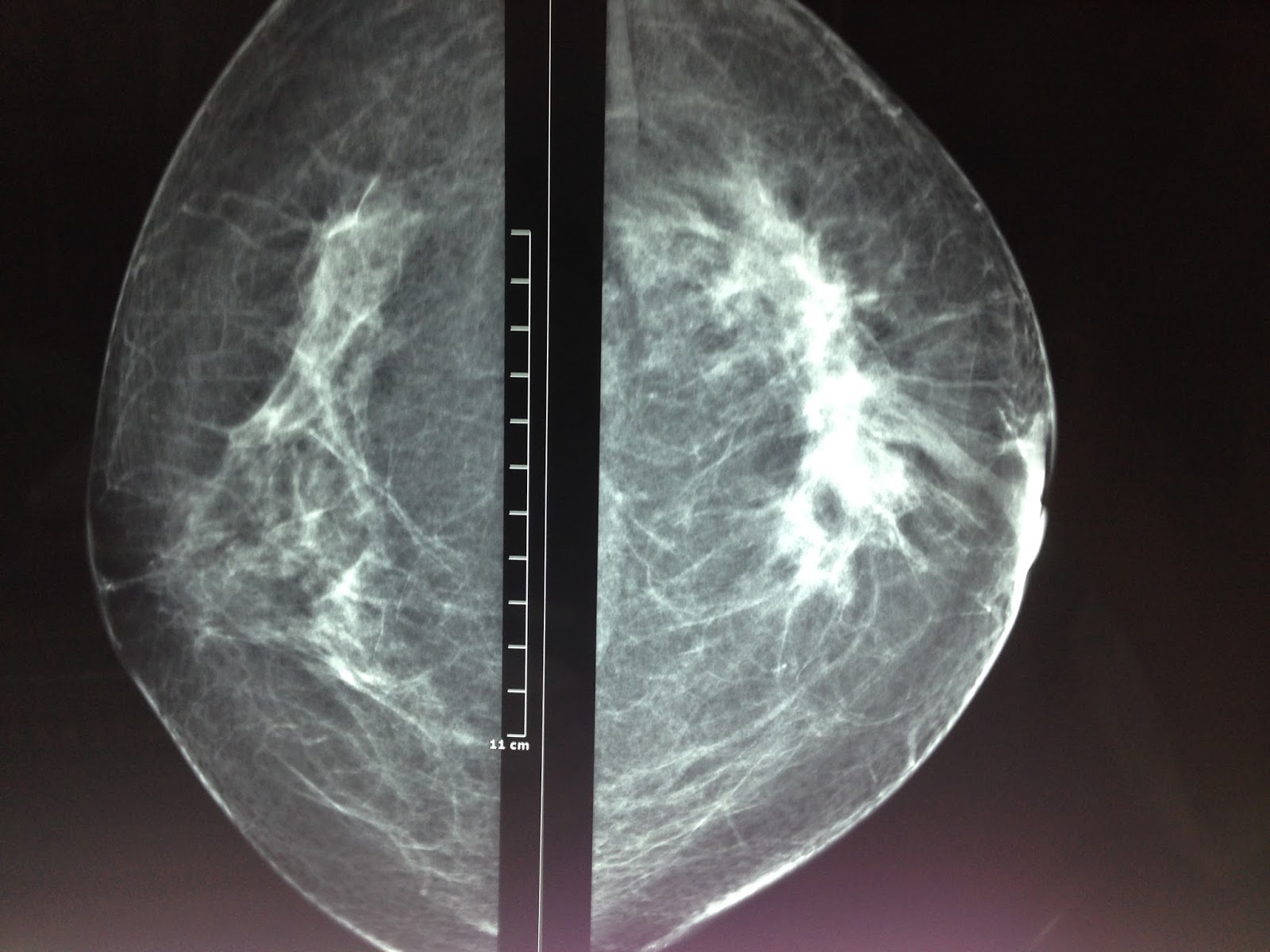 VIETNAMESE MEDIC ULTRASOUND: CASE 415 : BREAST TUMOR, Dr PHAN THANH HẢI ...