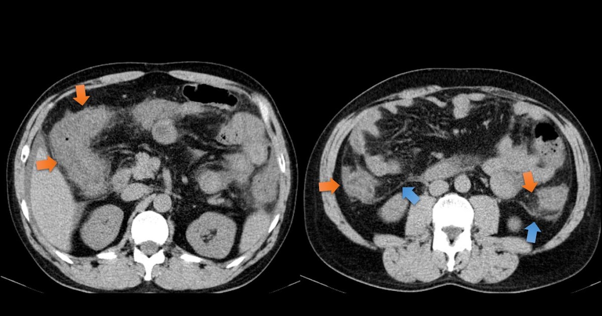 Ultimate Radiology : Eosinophilic Gastroenteritis