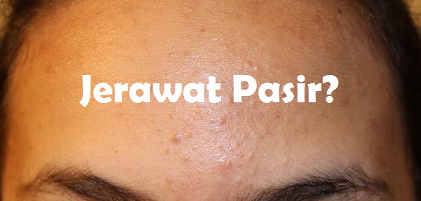Punca Skin Purging - Tips Kurus Cepat Dan Berkesan