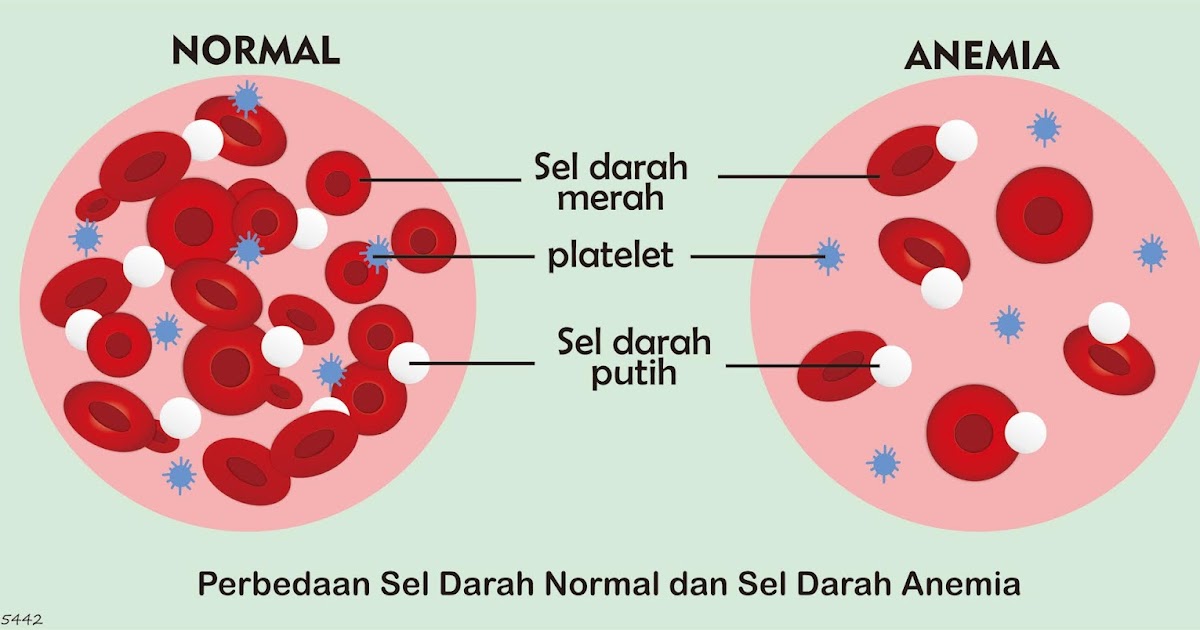 Gizi Kami Untuk Sehat Kita : Anemia Defisiensi Besi, Apa itu?