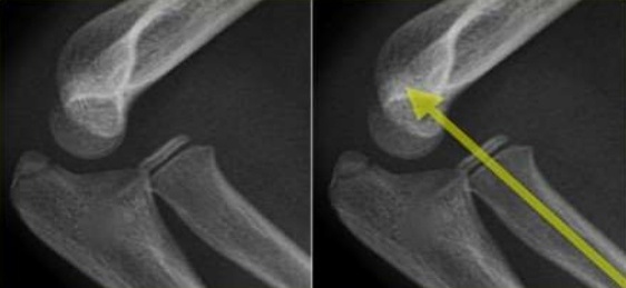 Eponymous fractures of Upper limb