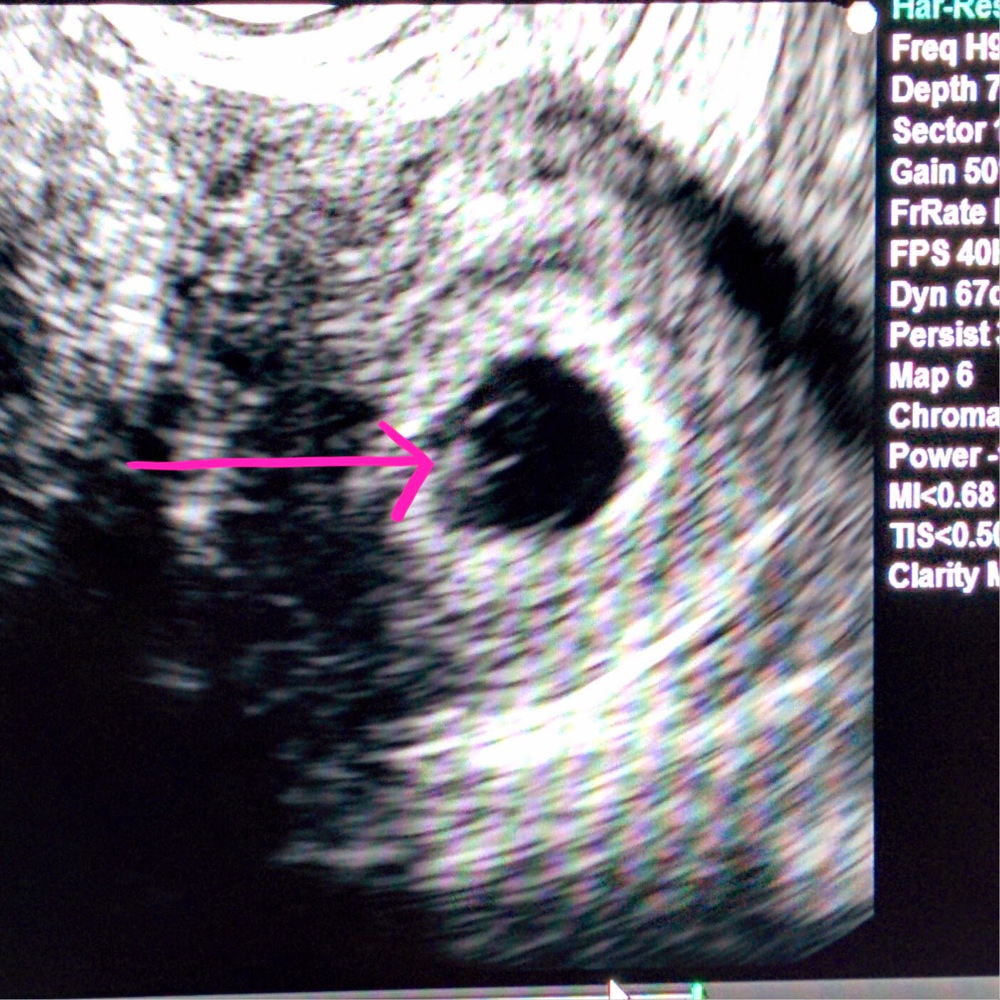 Hoping for Baby B: 6 weeks