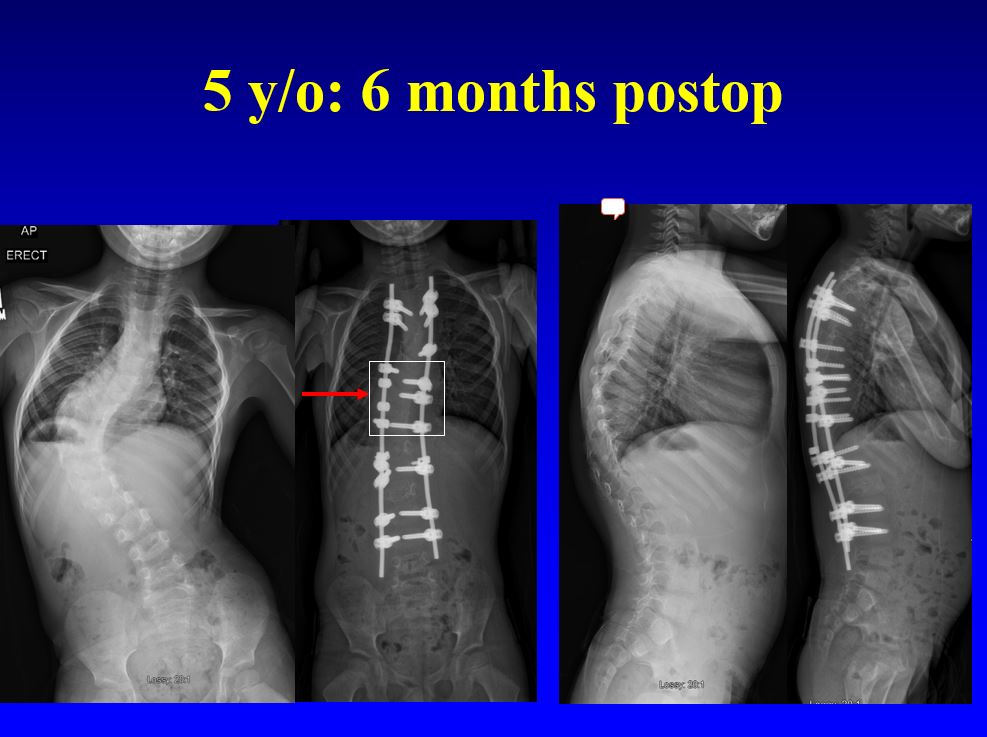 Surgical Treatment of Congenital Scoliosis | Growing Spine Blog ...
