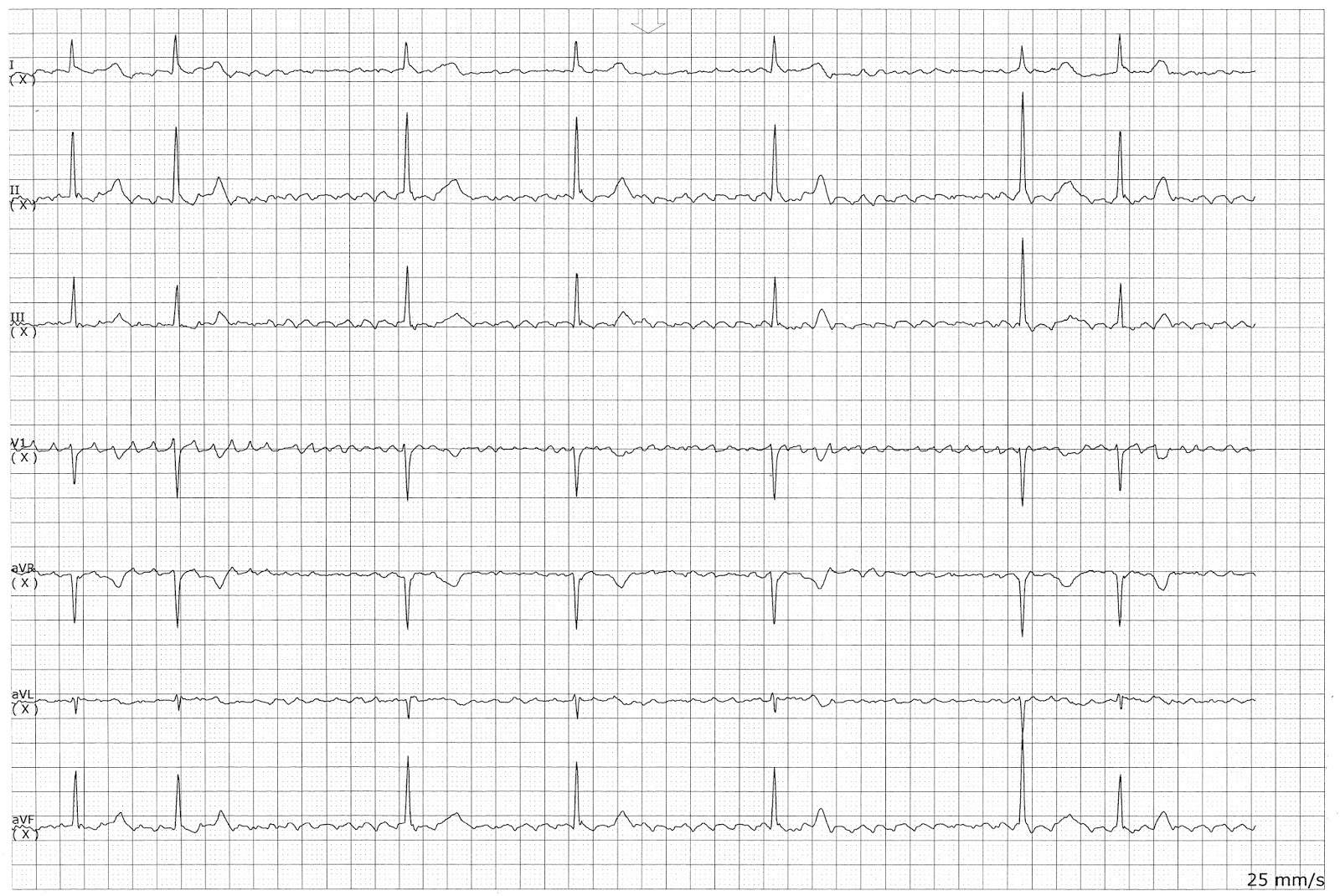 Ventricular Fibrillation