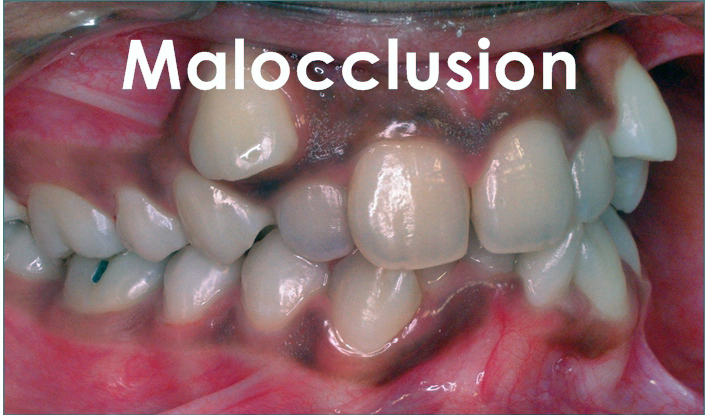 ORTHODONTICS TREATMENT: Causes of malocclusion and symptoms