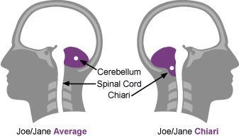 Chiari Hope: What is Chiari?