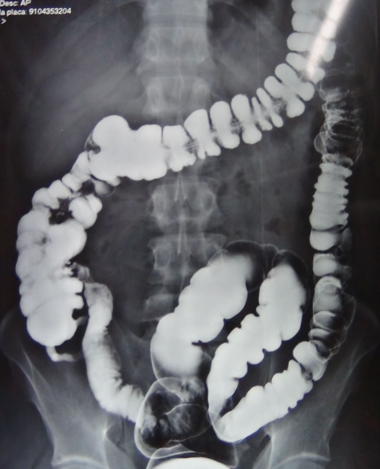 Endoscopia y Cirugía Digestiva: RADIOGRAFIA DE COLON POR ENEMA DE DOBLE ...