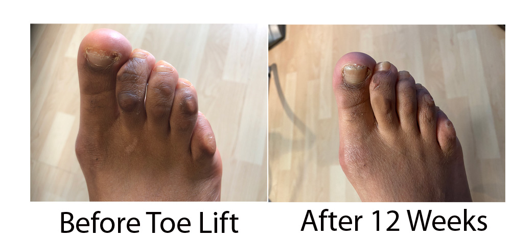 Toe Lift