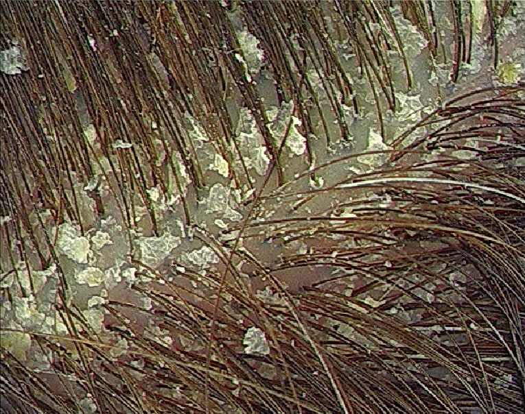 Axel Gabriel Tarazona Acosta: ¿Como combatir y curar la caspa?