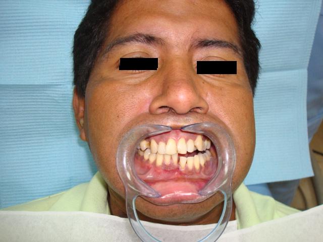 Dr. Alex Polit Luna- Cirujano Oral y Maxilo Facial.: Fractura Mandibular