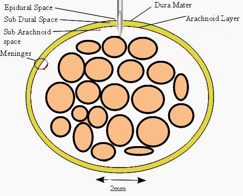 Myelogram Killer: 2. Pictures and Diagrams