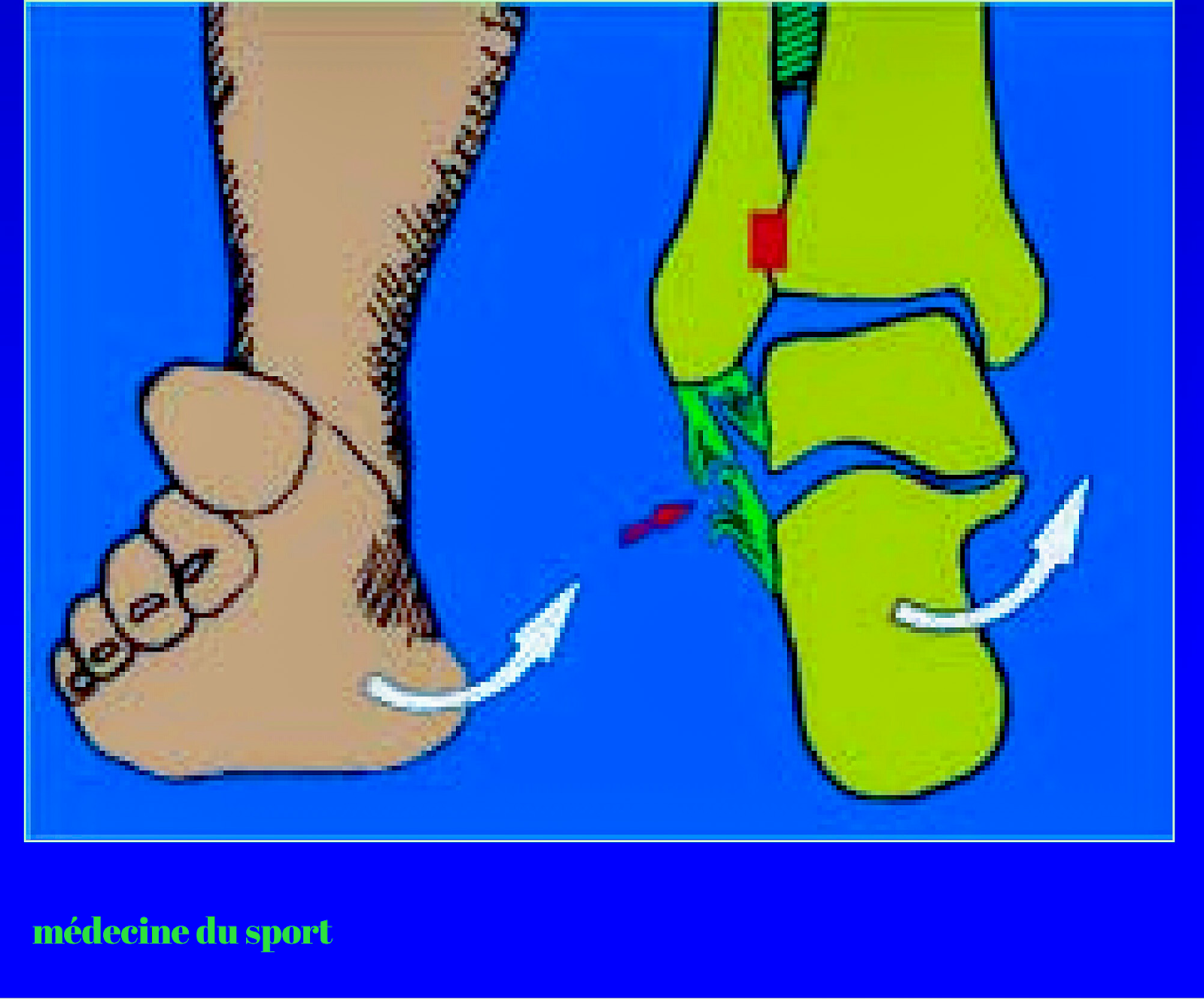LES ENTORSES DE LA CHEVILLE