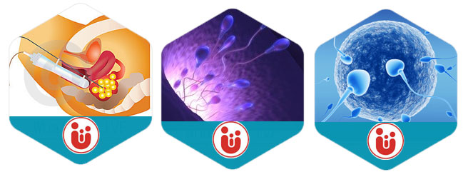 Urogyn clinic Is one of the Best IVF treatments in Delhi ~ Urogyn IVF ...