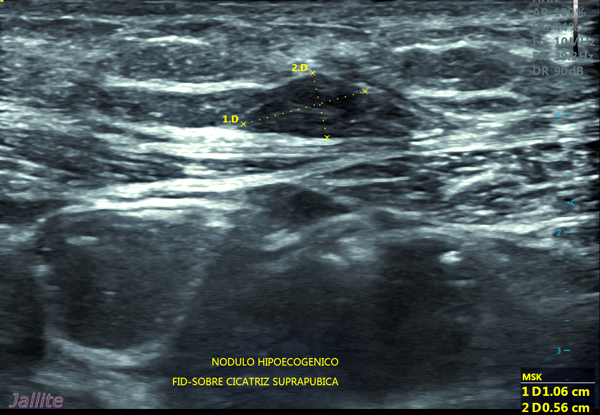Pseudoquistes & Nódulos Pared Abdominal