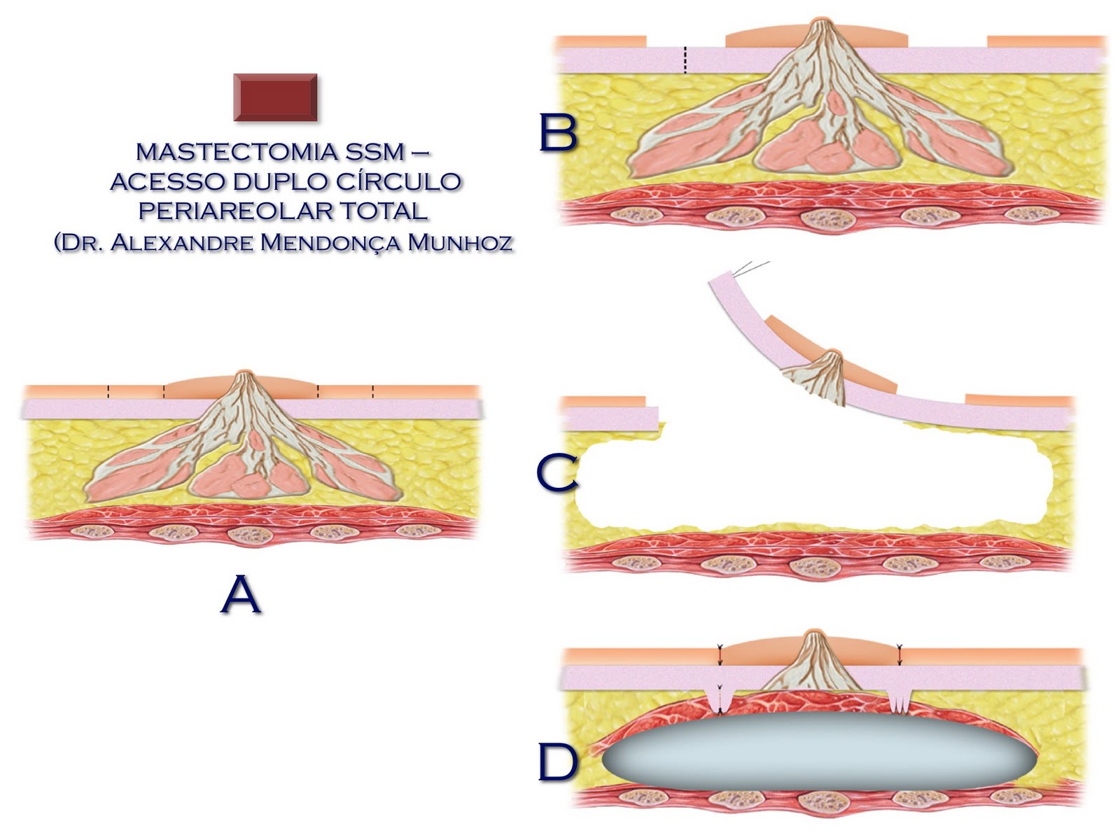 Reconstrução Mamária: Mastectomias com Preservação de Pele