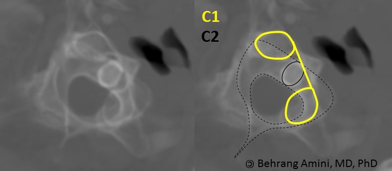 Roentgen Ray Reader: Suspected Type I Rotatory Atlatoaxial Subluxation ...
