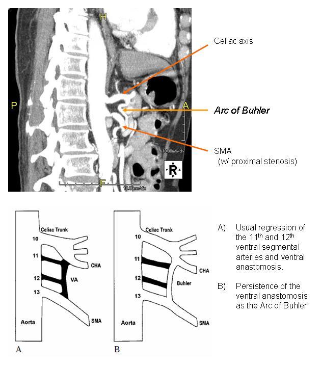 The Pump and the Tubes: Arc of Buhler