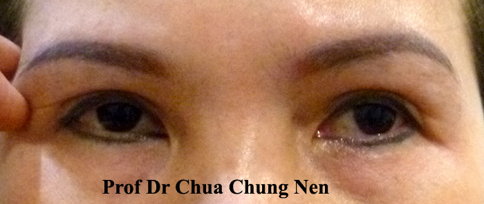 Eyelid Surgery by Prof Dr CN CHUA 蔡鐘能: Doc, Can You Remove the Excess ...
