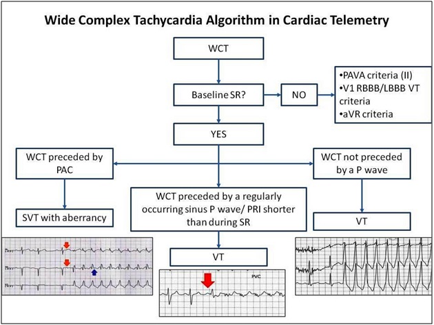 Wct Heart Rhythm