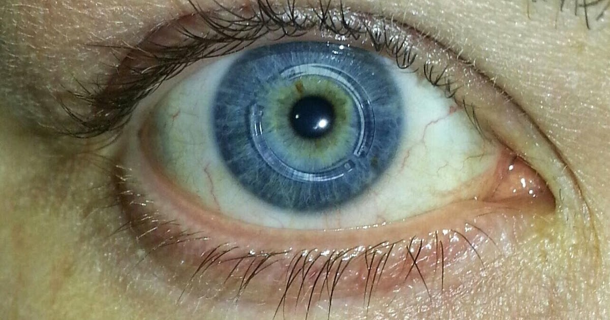 Intacs for Keratoconus (Photo by Helen Thompson) | Keratoconus Group