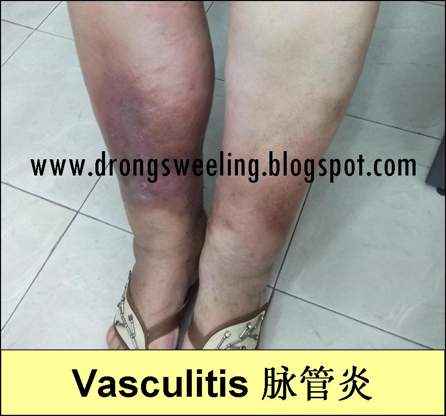 TCM News: TCM Clinic Physician treat Vasculitis on Lower Legs