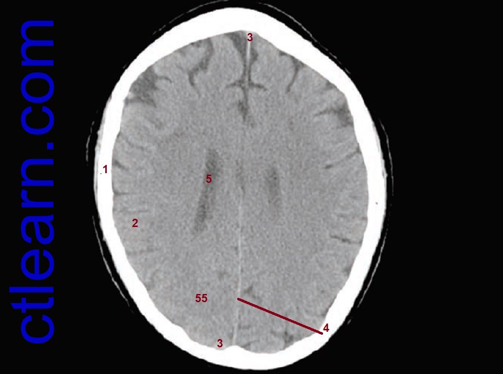 Learn CT Scan: Anatomy CT Axial Brain Learn CT Scan: Anatomy CT Axial Brain