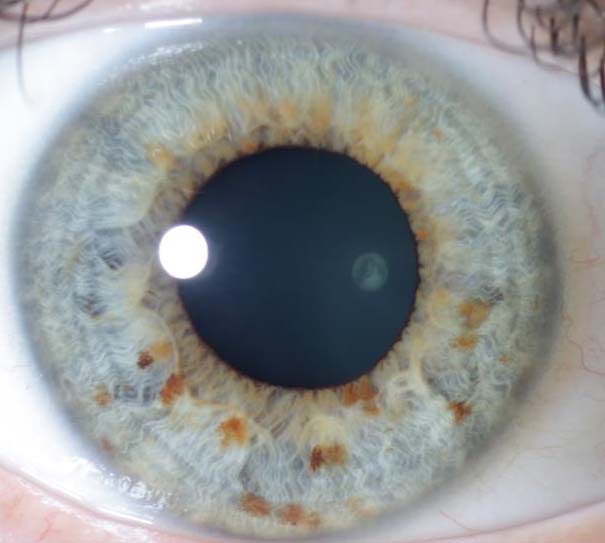 Modern & Multidimensional Iridology: Iris Pigmentation - Color, Density ...