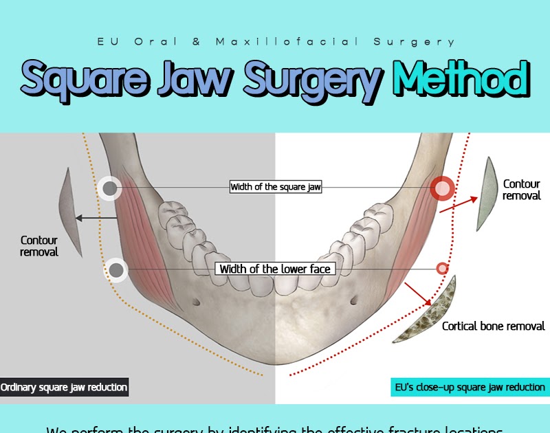 What is square jaw surgery?