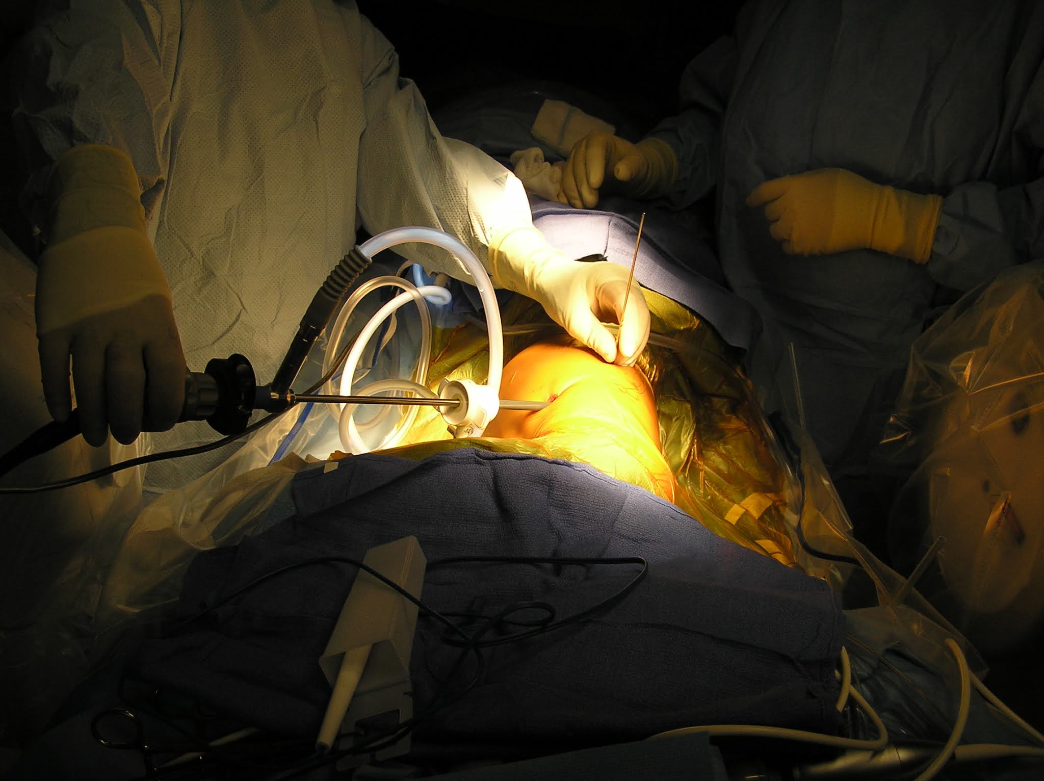 Vertebral Body Tether of Lumbar Scoliosis Curves | Growing Spine Blog ...