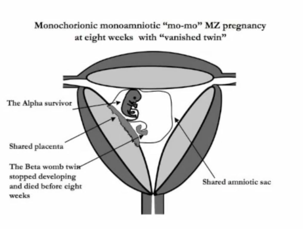 La Vida Intrauterina: El shock de la muerte prenatal del gemelo: Las ...