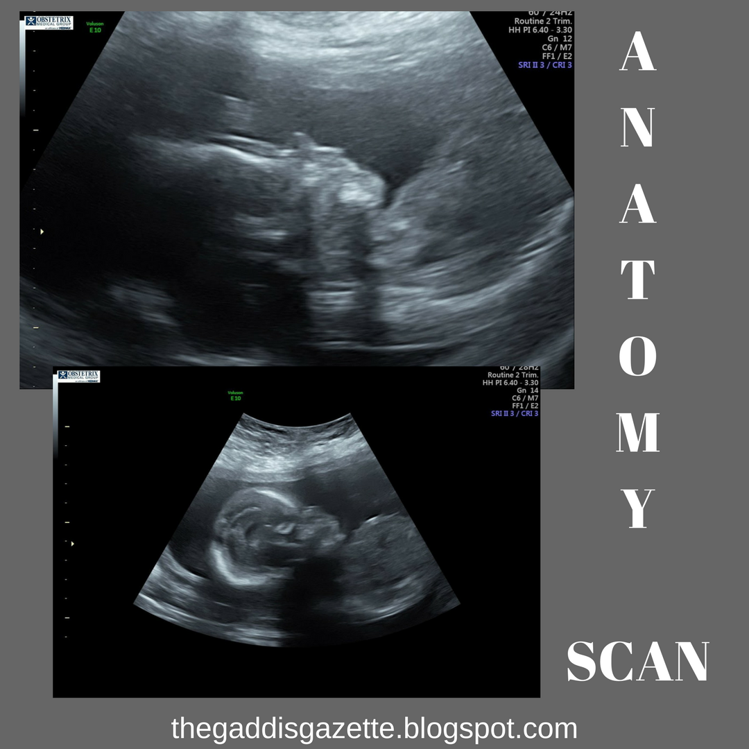 The Gaddis Gazette Pregnancy 2 Anatomy Scan Gender Reveal Down The Gaddis Gazette Pregnancy 2 Anatomy Scan Gender Reveal Down