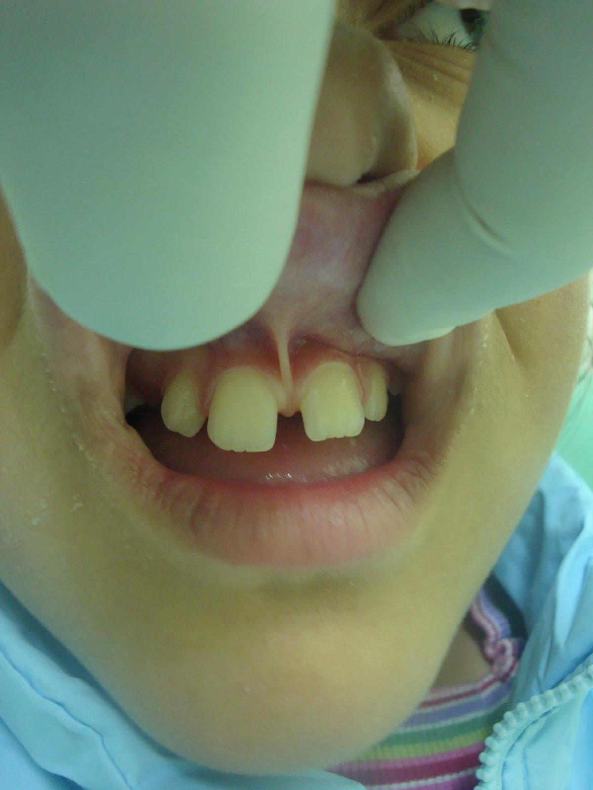 Frenectomia Labial - CIRURGIA BUCOMAXILOFACIAL