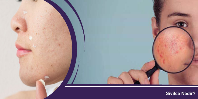 AyşeNur: Sivilce Nedir