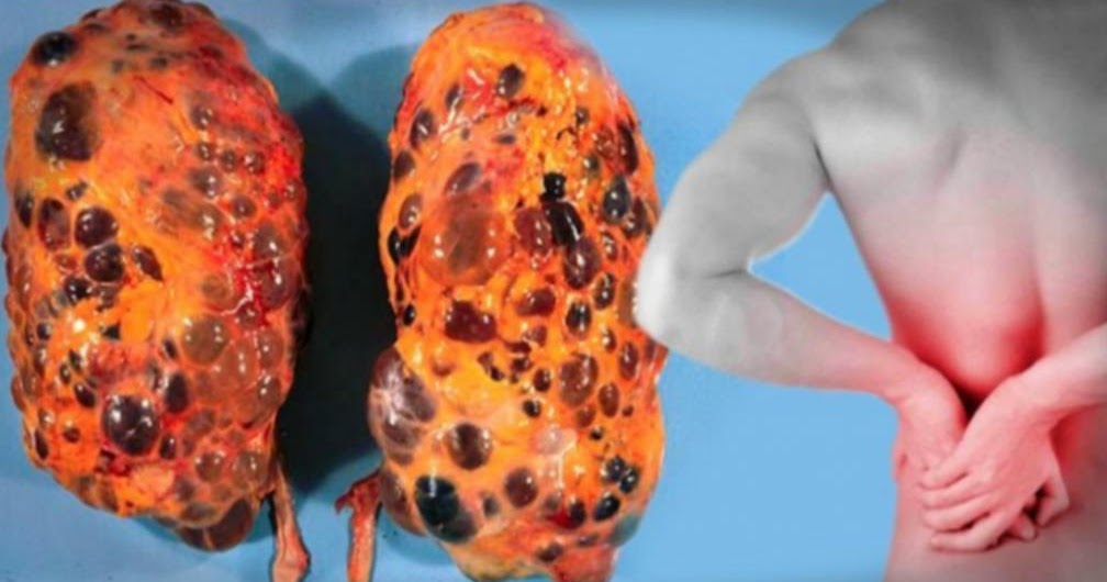 Shared Health News: Bad Habits That May Be Damaging Your Kidneys