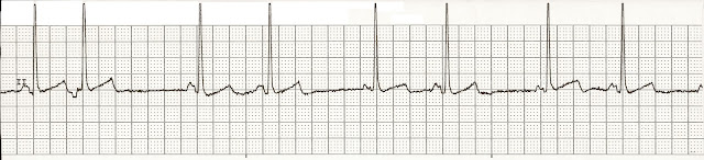 Float Nurse: EKG Rhythm Strips 24: Ectopic beats