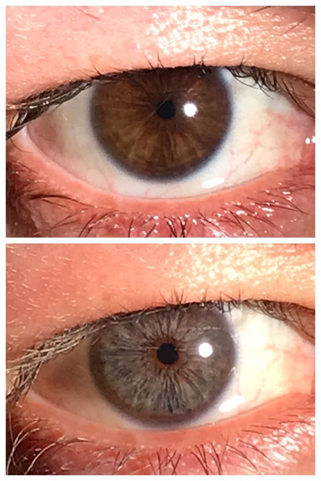 Laser Surgery Helps to Change Eye Color Permanently