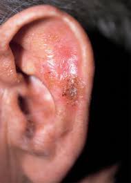 Squamous cell carcinoma ear pictures - All Cancer