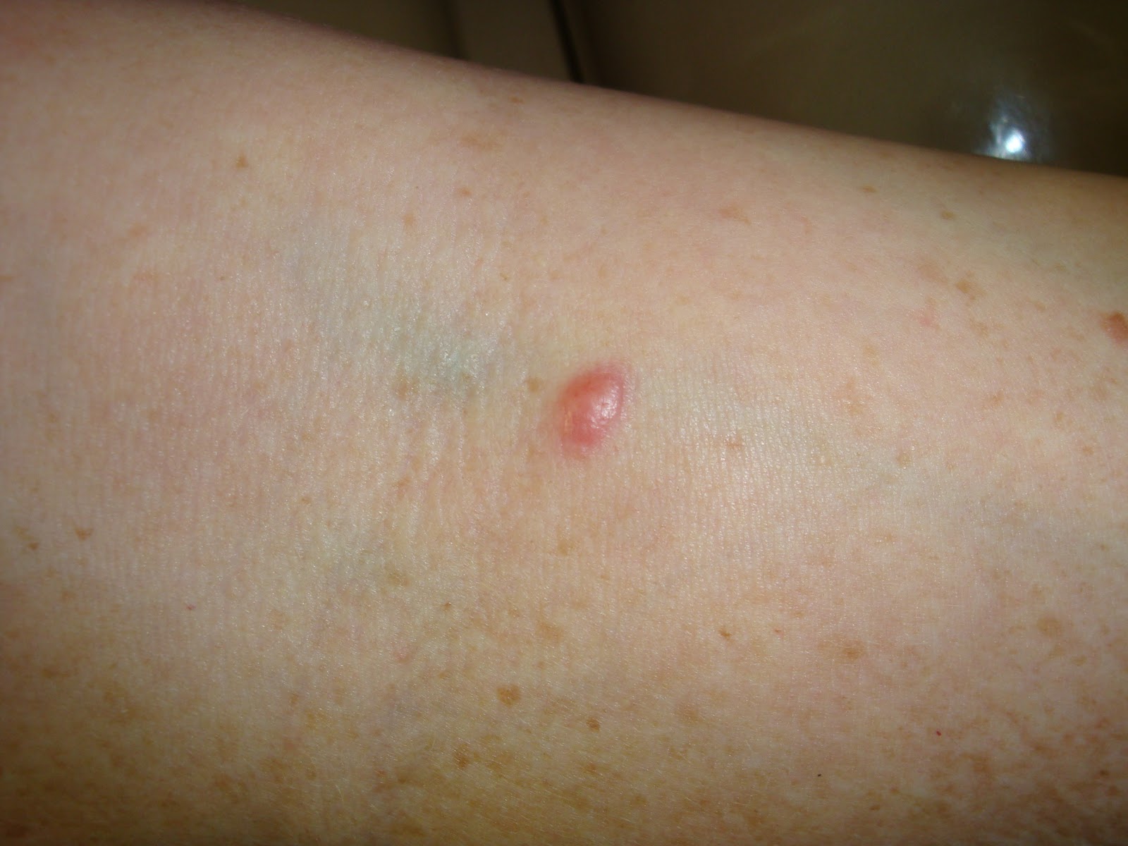 Consultations in Dermatoscopy: Pink and Purple