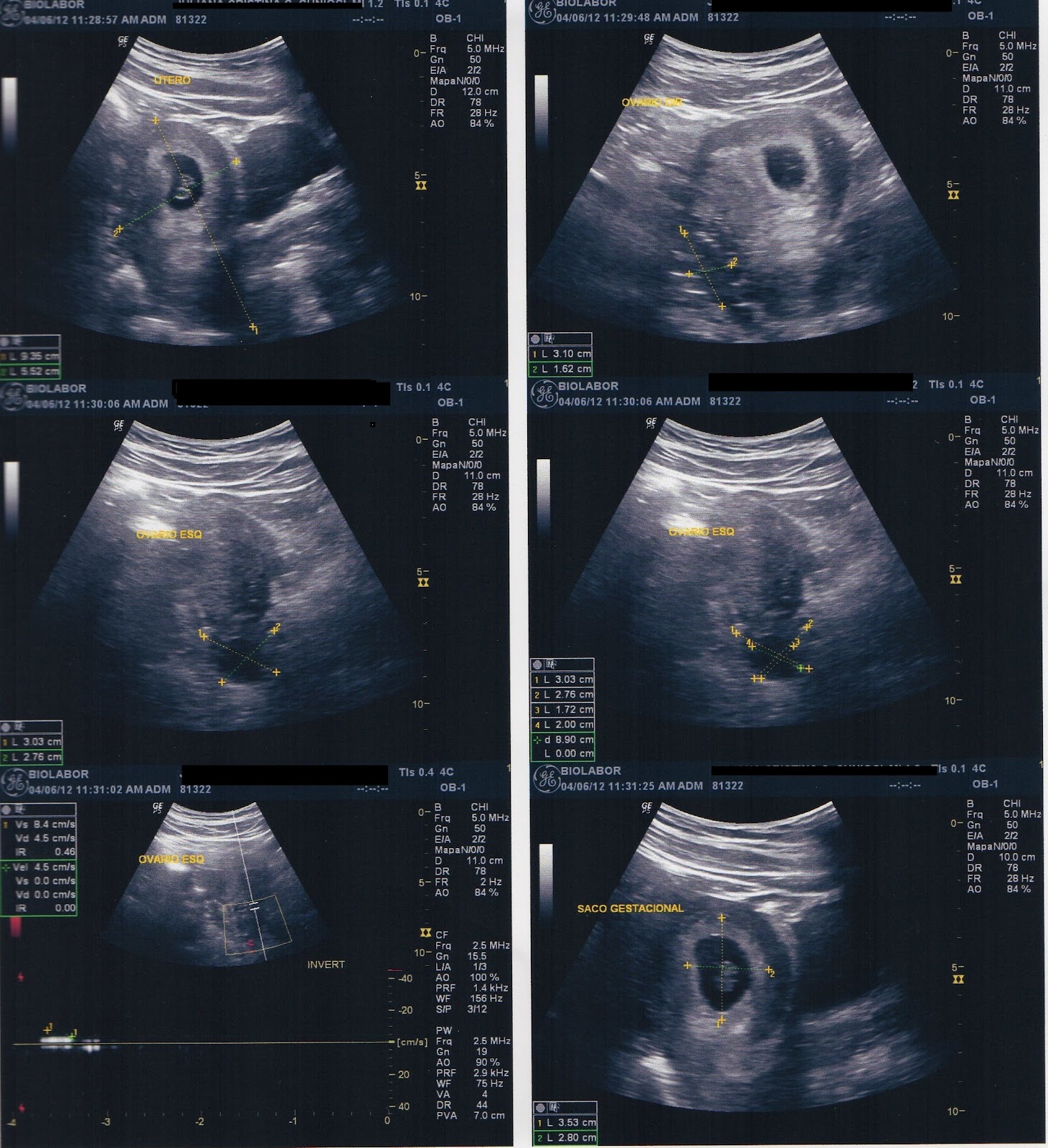 Imagens De Ultrassom De 1 Mes