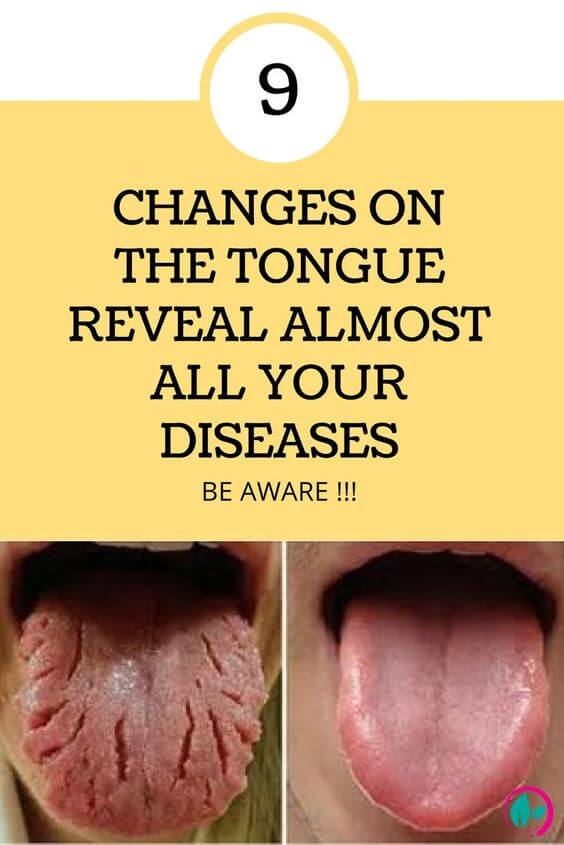 BE AWARE OF THIS: THESE 9 CHANGES ON THE TONGUE REVEAL ALMOST ALL YOUR ...