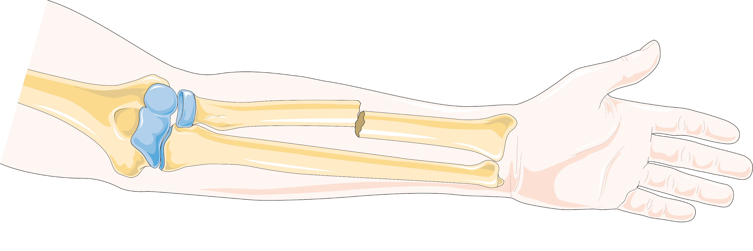 Segmental Fracture Treatment | Segmental Bone Surgery