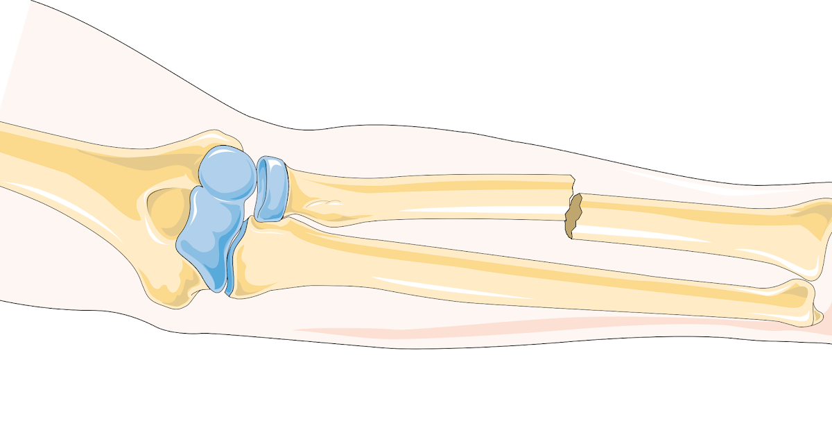 Segmental Fracture Treatment | Segmental Bone Surgery