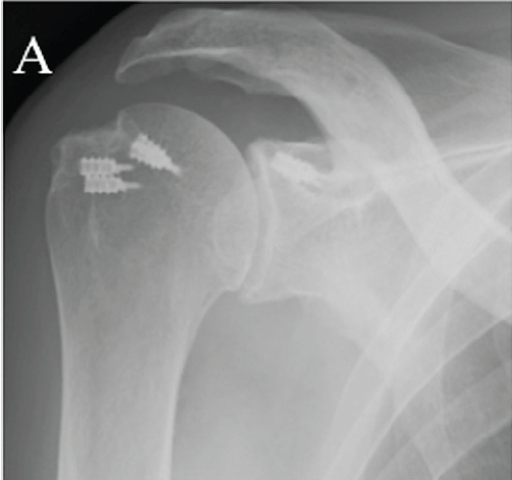 Shoulder Arthritis / Joint Replacement : Superior capsular ...