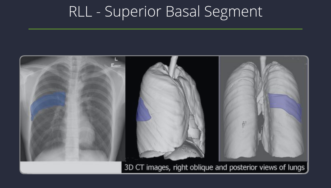 Medicowesome: Chest X-ray - Right Lung!
