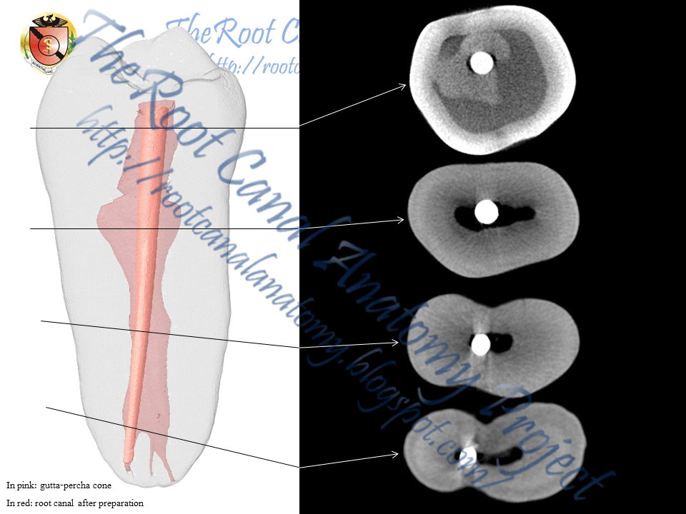 The Root Canal Anatomy Project: Conservative Endodontic Access ...