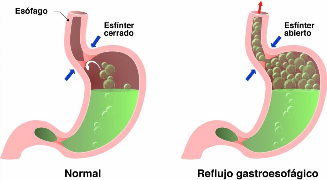 ENFERM-EDADES: Adultos. Diagnóstico. ERGE