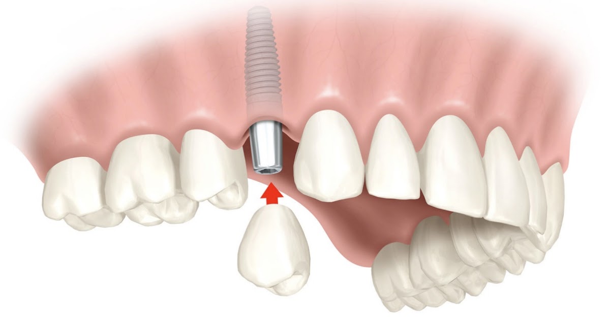 Papo com o Dr. Arion: POR QUE DEVO COLOCAR UM IMPLANTE?
